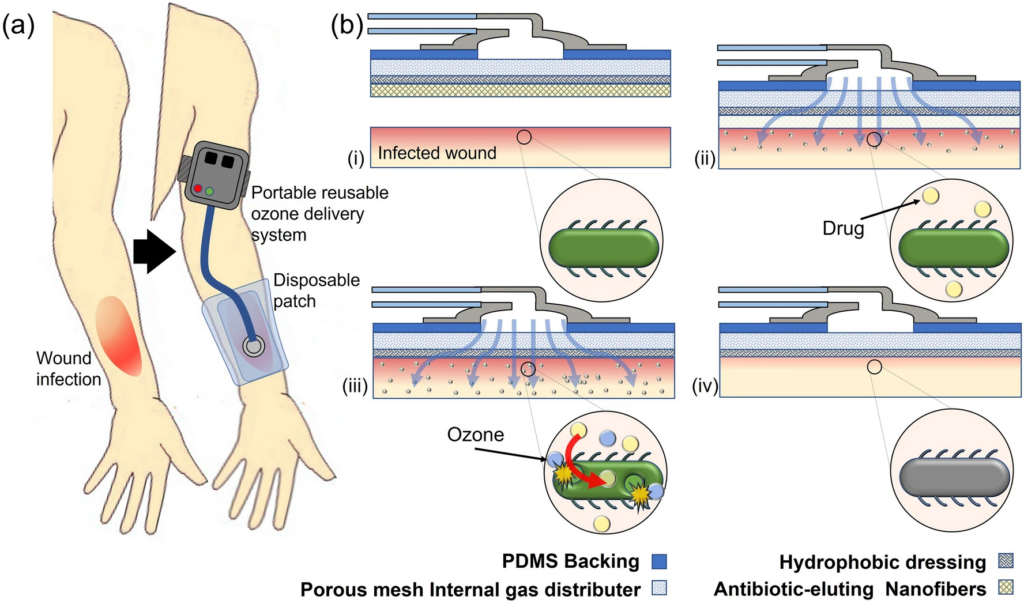 Wearable adjunct ozone and antibiotic therapy system for treatment of ...
